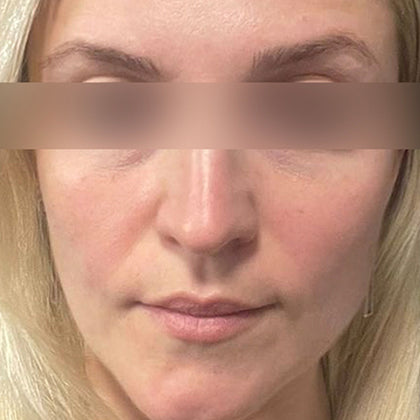 Surface [CR] | Smoothing Wrinkle Corrector | ALPHASCIENCE